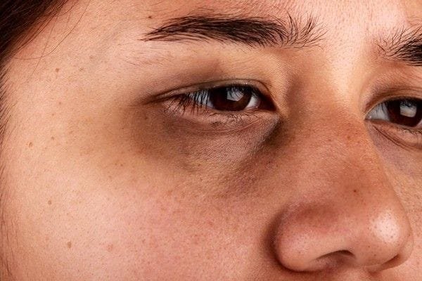 Kantung Mata Anda Menghitam? Ini Cara Mengatasinya